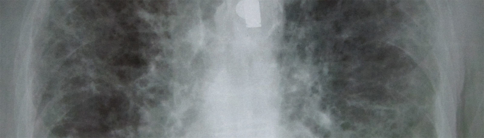 UBC researchers receive $7.2 million to develop test for pulmonary ... UBC researchers receive $7.2 million to develop test for pulmonary ...